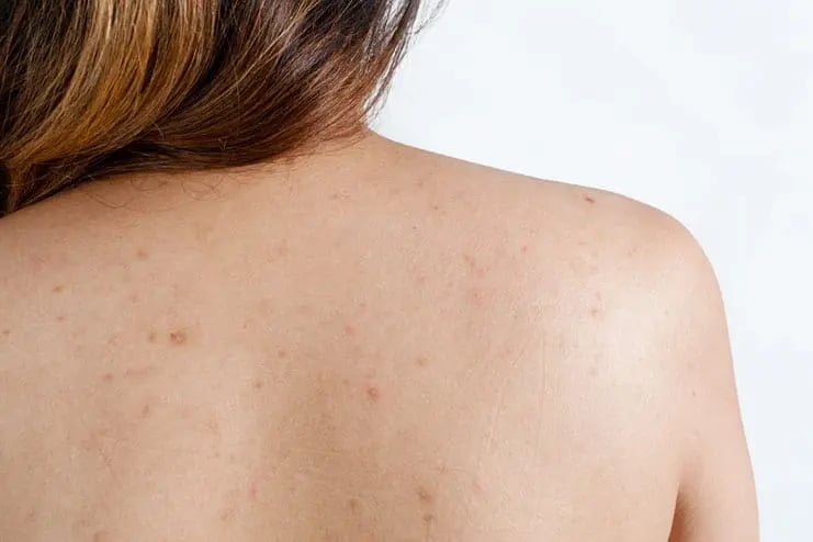 Body Acne Treatment - Houston Acne Specialists